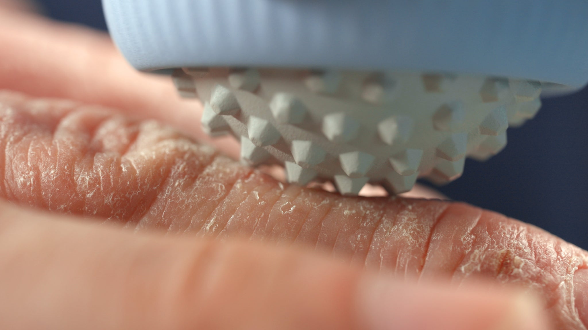 Rollerball Itch Relief Device | Rollo Singapore – Rollo SG